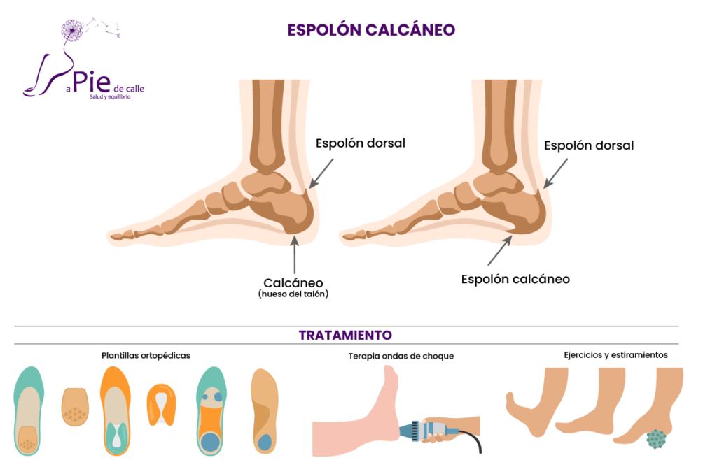 Beneficios de caminar con espolón en el pie | Nutriaventura
