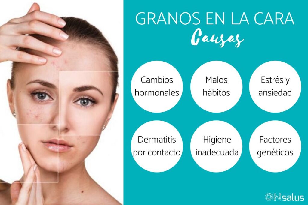 Causas y tratamiento de los granos en el rostro: consejos efectivos ...